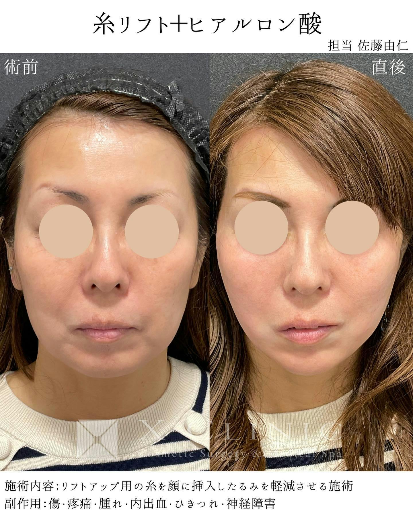 糸リフト(スレッドリフト)・ヒアルロン酸注射・注入の症例写真・ビフォーアフター画像No.7033 | X CLINIC (エックスクリニック) 大阪院