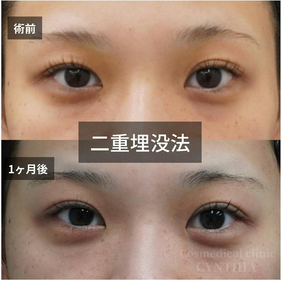 二重整形・二重埋没・奥二重整形・末広二重整形・平行二重整形・ミックス型二重整形・目元整形の症例写真・ビフォーアフター画像No.7542 ...