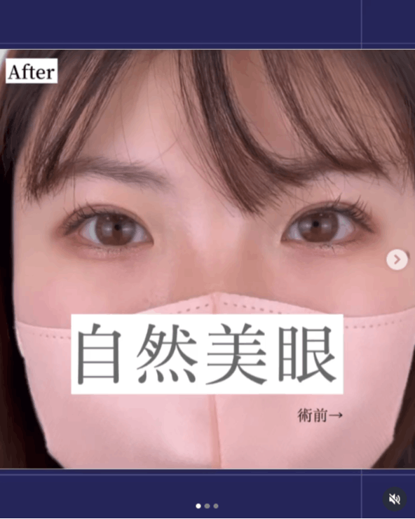 二重埋没の症例写真・ビフォーアフター画像No.7280 | ナルビューティークリニック(NARU Beauty Clinic)