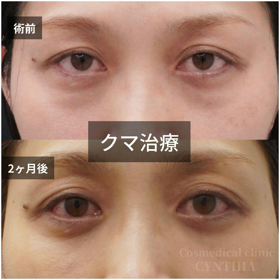 目の下のクマ・たるみ取り・経結膜脱脂法・目元整形の症例写真・ビフォーアフター画像No.7557 | コスメディカルクリニック シンシア 渋谷院